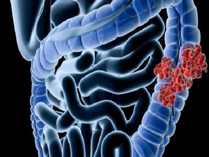 Bowel Cancer: Symptoms, causes, stages and prevention