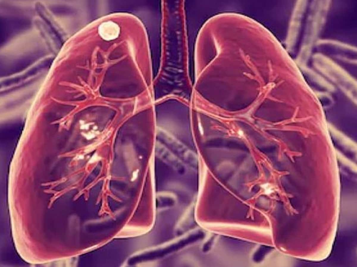 Pneumonia Can Be Fatal Without The Right Treatment: Ensure Timely ...