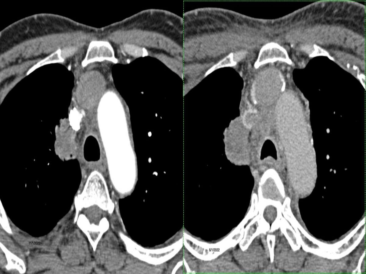 Stage-4 lung cancer patients may develop superior vena cava syndrome ...