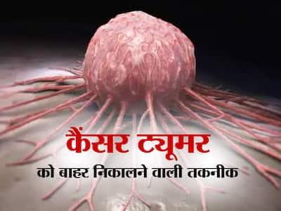 कैंसर रोगियों के सेल्स को नुकसान पहुंचाए बिना निकलेगा ट्यूमर! डॉक्टर ने ...