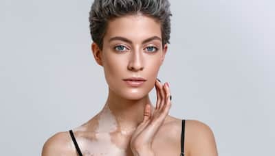 How To Detect Vitiligo? Signs People Should Look Out For ...
