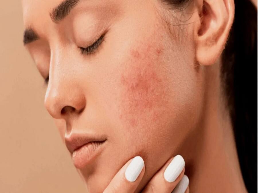 Don't Ignore Facial Redness; It Could Be A Sign Of A Serious Skin ...