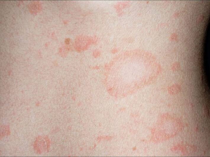 स्किन पर भी दिखायी देते हैं विटामिन C की कमी के लक्षण, ये समस्याएं हो ...