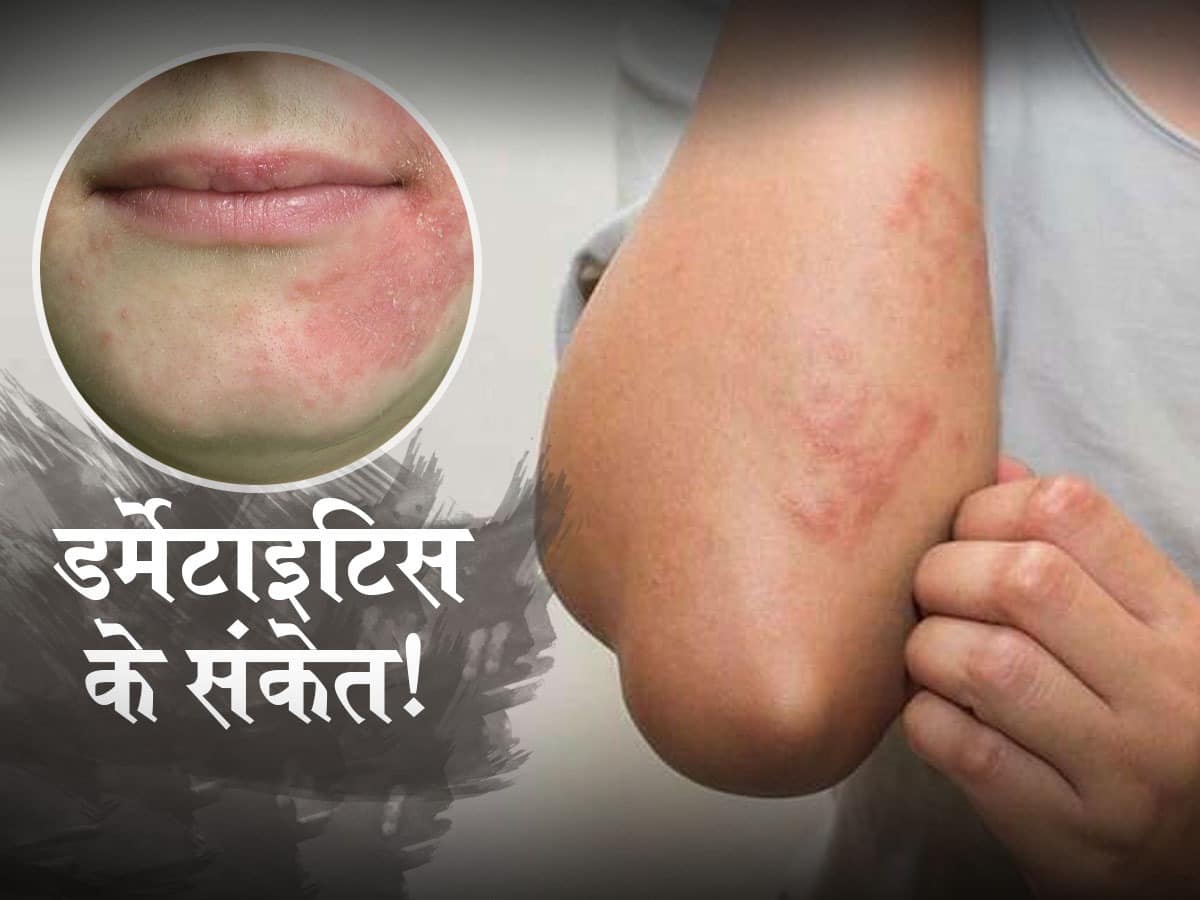 Dermatitis: स्किन पर हो रहे हैं लाल और सफेद निशान? इस गंभीर त्वचा रोग ...