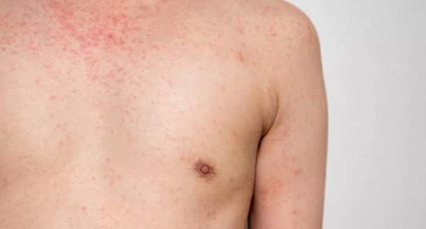 Rubella - Health Tips, Rubella Health Articles, Health News ...