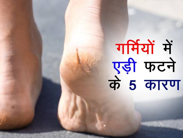 गर्मियों में एड़ी फटने के 5 कारण | Crack heels causes in summer in ...