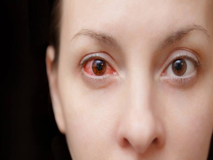5 Signs Of Covid Infection That Show Up In Your Eyes | TheHealthSite.com