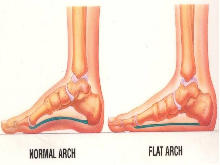 Flat feet - Health Tips, Flat feet Health Articles, Health News ...
