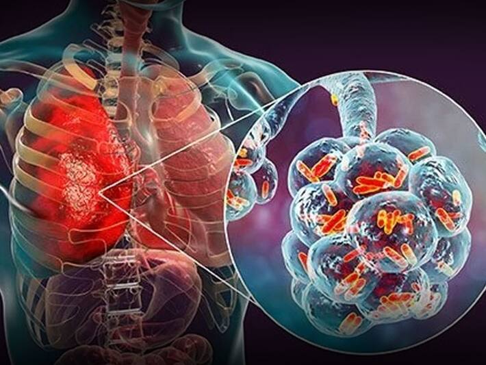 Pneumonia: How Fluid Forms Inside The Lungs And Then Damages It ...