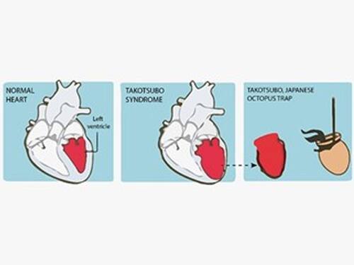 Takotsubo Cardiomyopathy: Symptoms, Causes, Treatment | TheHealthSite.com