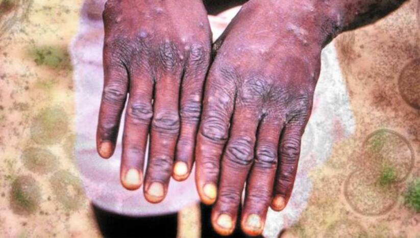 New Symptoms of Monkeypox: Painful Inflammation In Rectum Can Be A ...