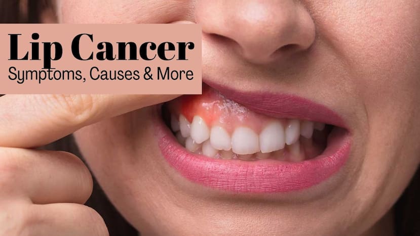 Lip Cancer: Unexplained Bleeding, Numbness And Other Symptoms of This ...