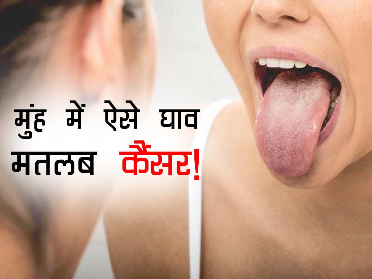 Lips Cancer Symptoms In Hindi