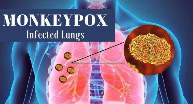 African Swine Flu Grips Kerala To Hyderabad Man Developing Monkeypox ...