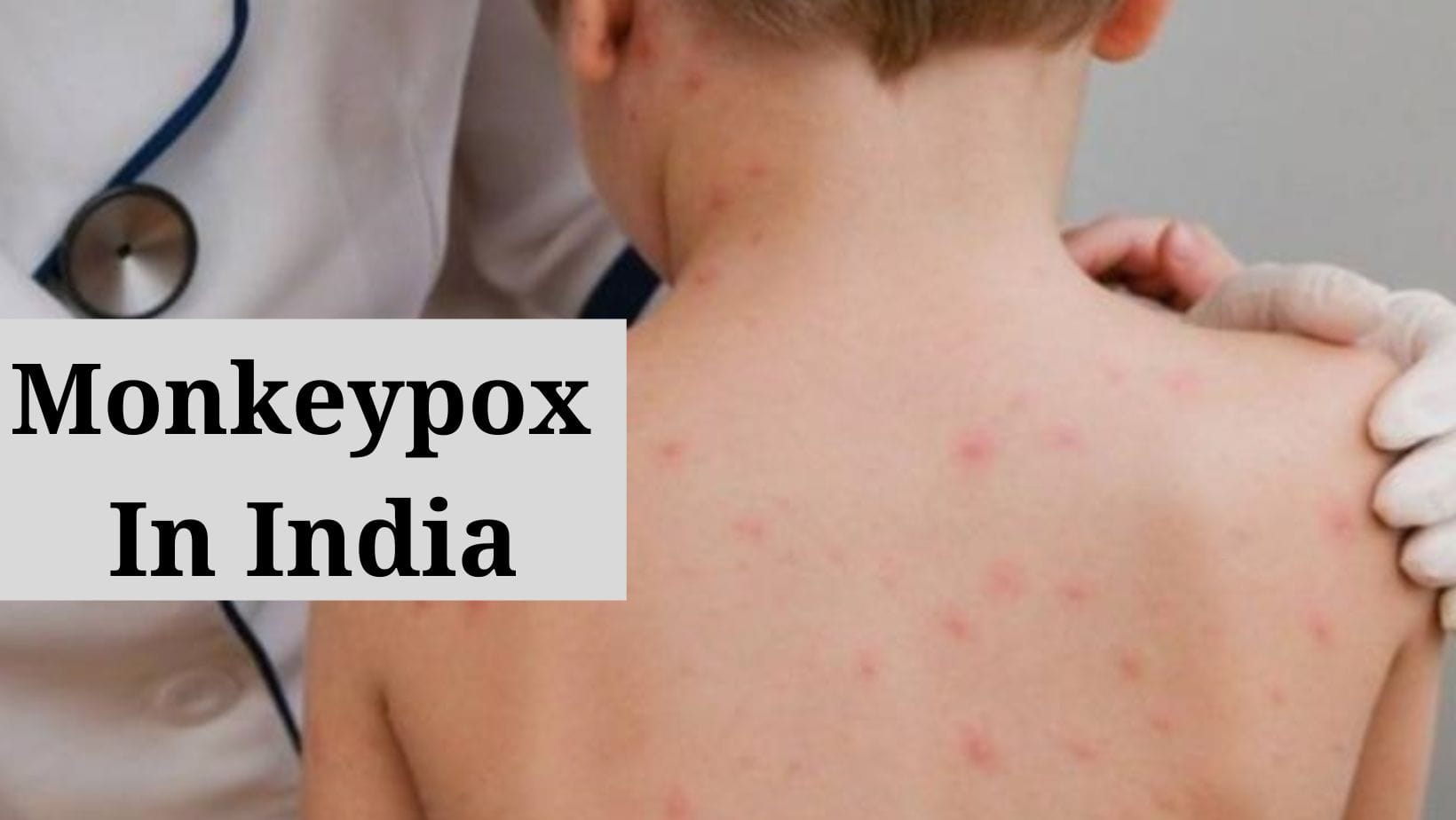 Monkeypox In India: 8-Year-Old Shows Up Symptoms In Andhra Pradesh ...