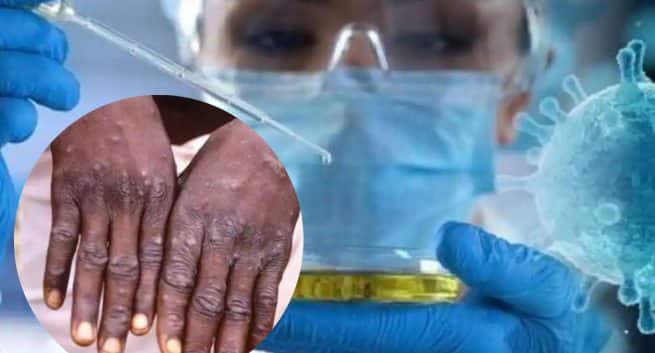 Monkeypox Spreading Slowly In India To Swine Flu Deaths Surge In ...