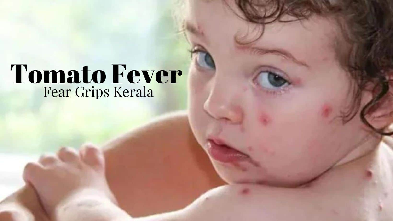 Tomato Fever Fear Grips Kerala: 5 Tips To Protect Your Kids From ...