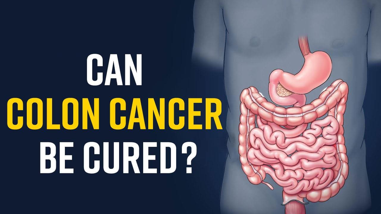 Colon Cancer: Know The Signs, Stages and Treatment for Colon Cancer ...