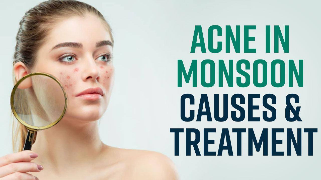Monsoon Skin Care: How To Treat Acne At Home During Monsoon Season ...