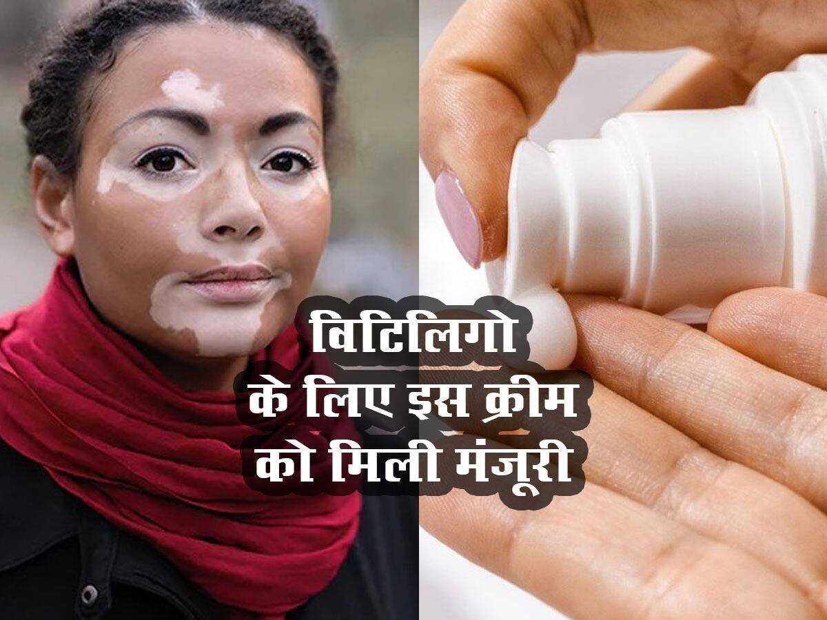 FDA ने विटिलिगो के इस क्रीम को दी मंजूरी, जानें क्या है इस दवा की ...