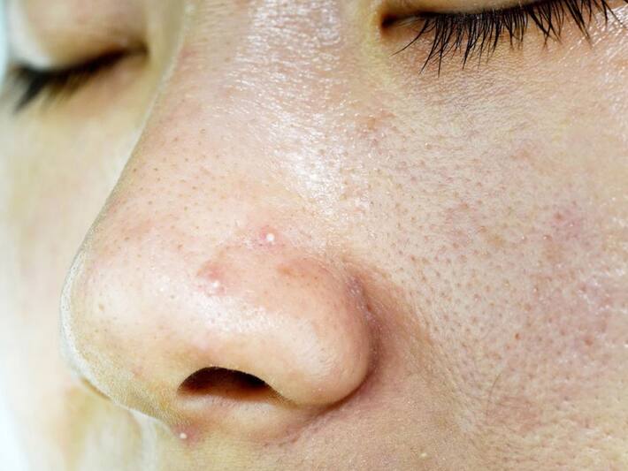 हाई कोलेस्ट्रॉल के संकेत हो सकते हैं चेहरे में दिखने वाले ये 5 बदलाव ...