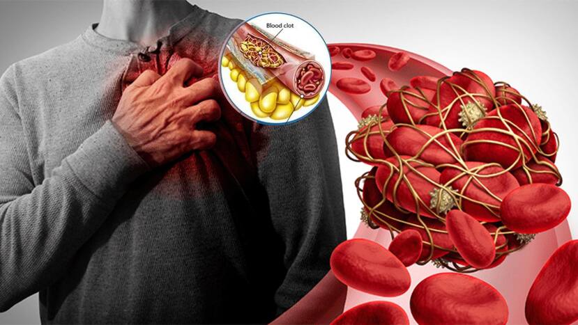 Blood Clotting Disorders: 7 Unusual Signs And Symptoms You Should Never ...
