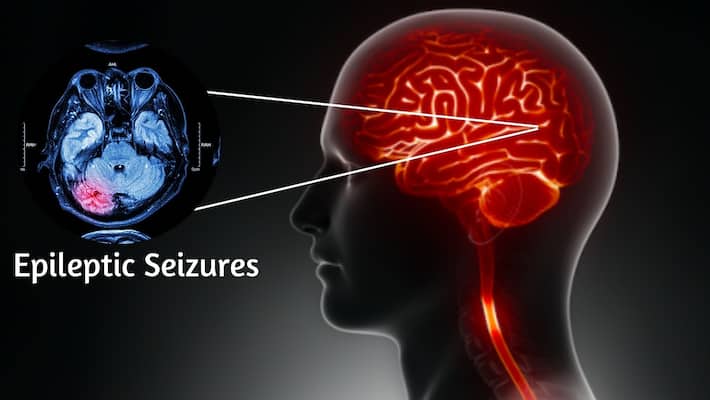 Why Are Epileptic Seizures Hard To Diagnose? Here Are The Early Signs ...