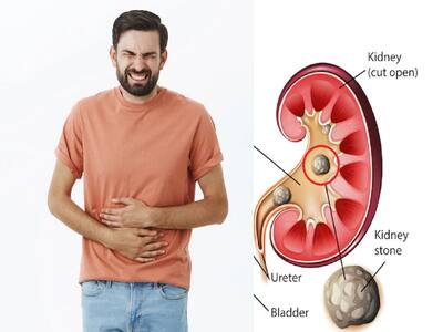 Eat These Foods To Prevent Recurrent Kidney Stones | TheHealthSite.com