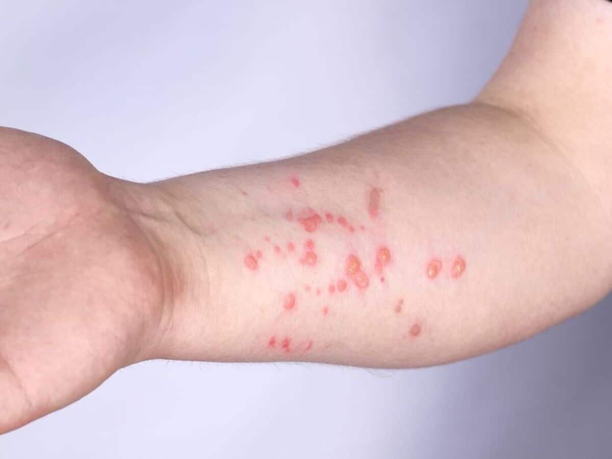 Tecovirimat May Be The ‘Silver Bullet’ That Could Help Treat Monkeypox ...