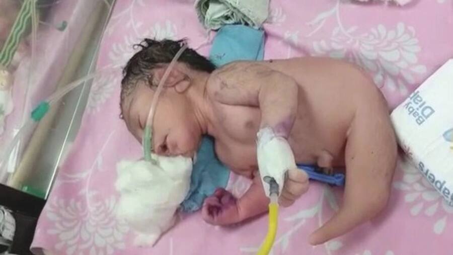 Child With Horn-like Structure Instead Of Legs Leave Doctors Shocked: 5 ...