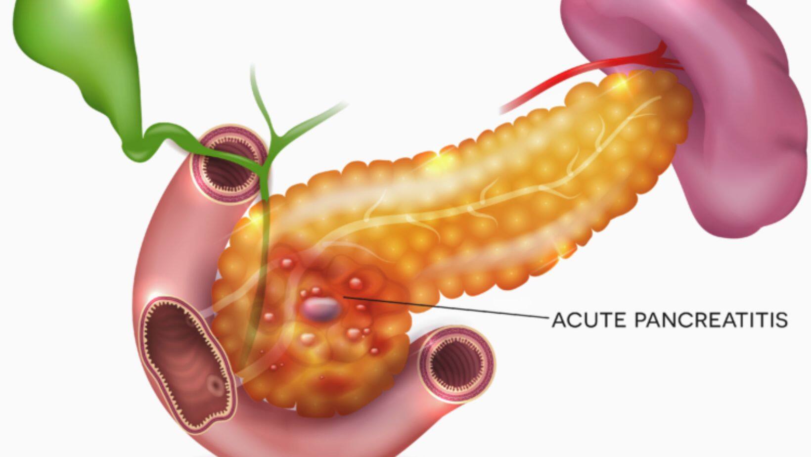 Acute Pancreatitis: 7 Symptoms That Says Your Pancreas Are Not Working ...