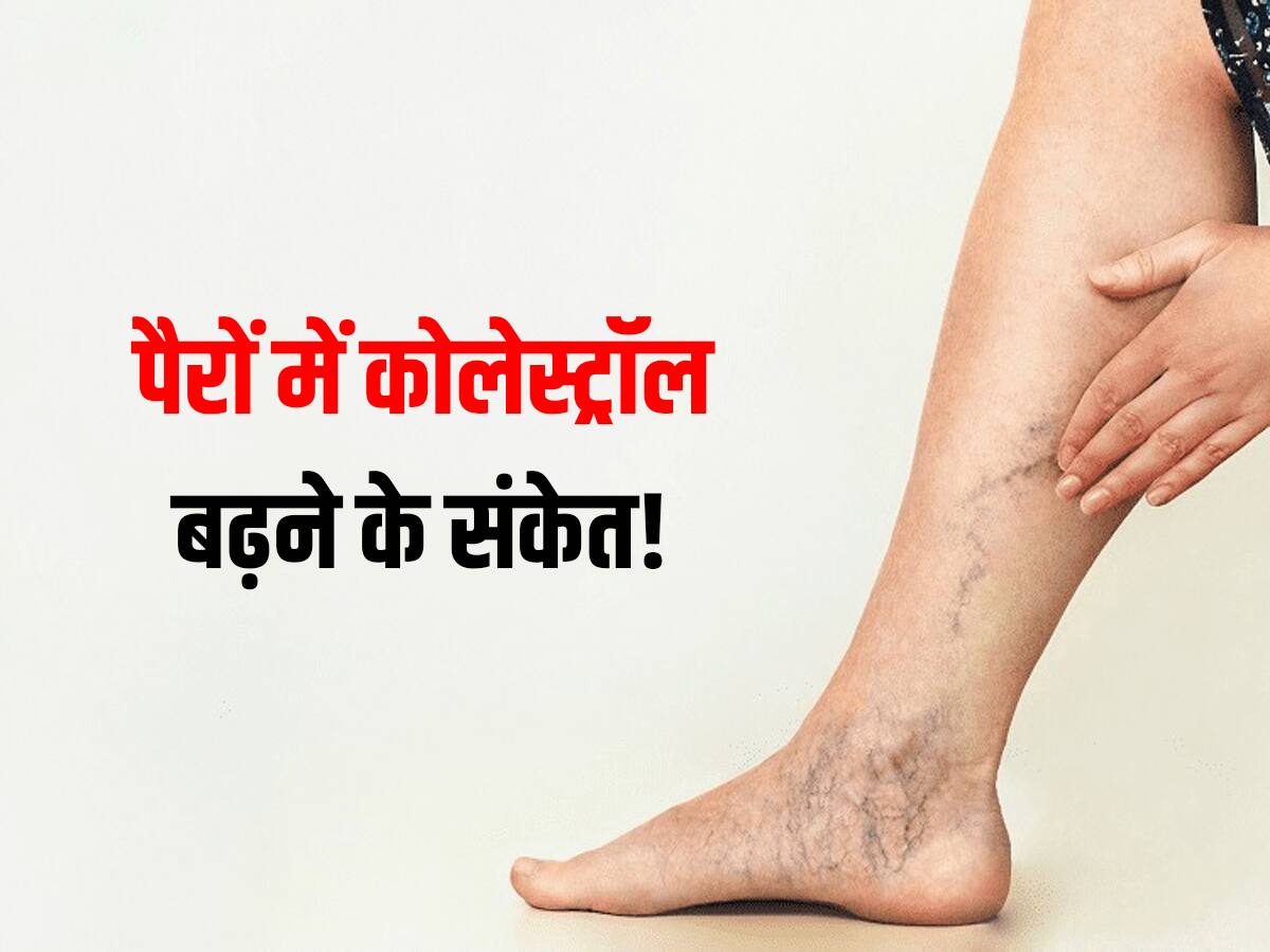 Signs of high cholesterol in legs : सोते वक्त पैरों में ये 4 बदलाव ...