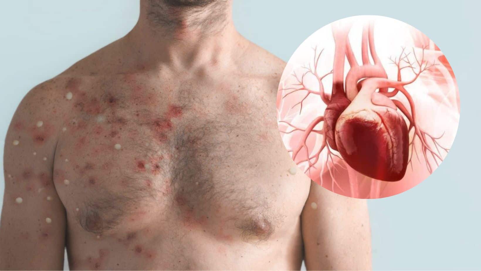 Man Infected With Monkeypox Virus Develops Serious Heart Issues; Study ...