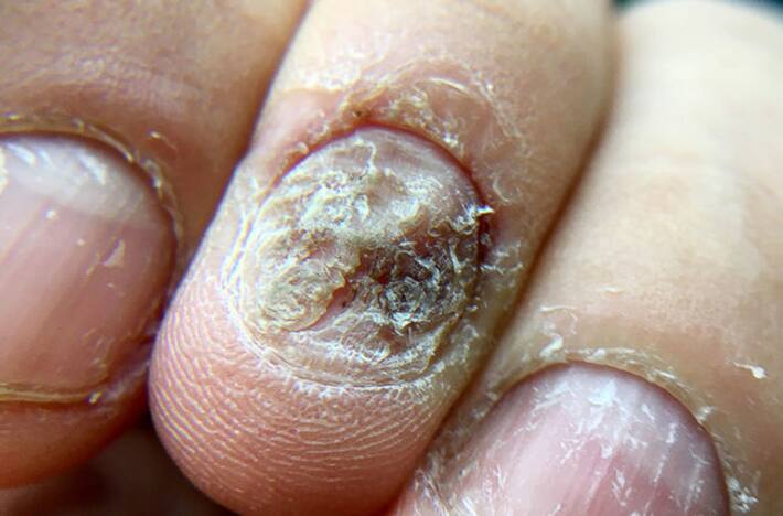 Nail Problems in Pictures | TheHealthSite.com