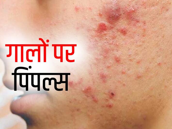 पिंपल्स देख कर जानें किन बीमारियों के हो सकते हैं आप शिकार, जानें क्या ...