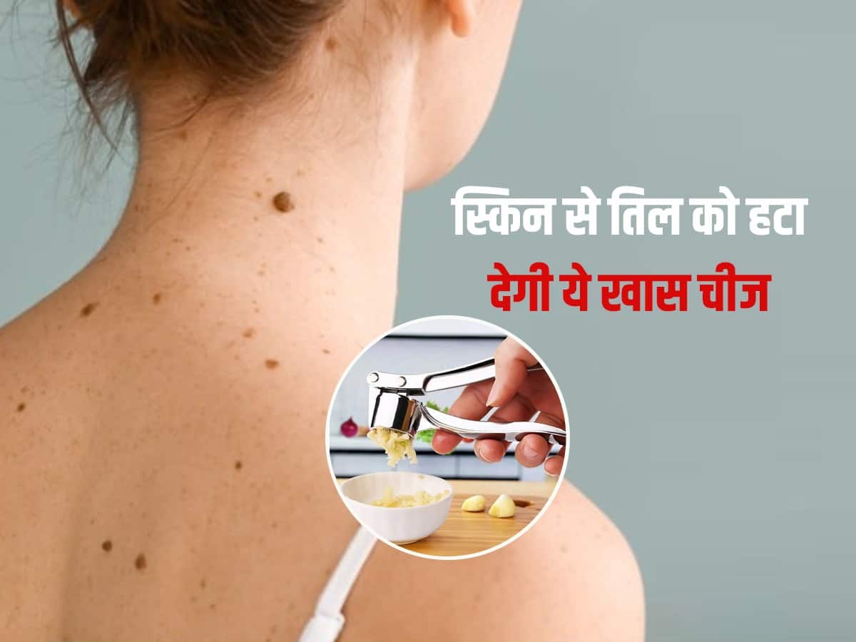 Mole removal at home :इस एक सब्जी से हटाएं तिल, नहीं होगा कोई साइड ...