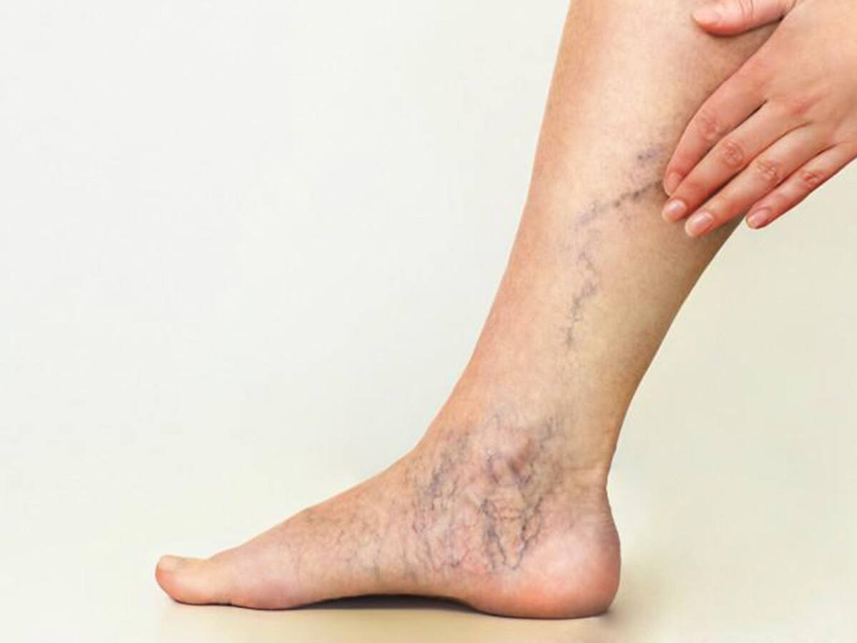 Signs of high cholesterol in legs : सोते वक्त पैरों में ये 4 बदलाव ...