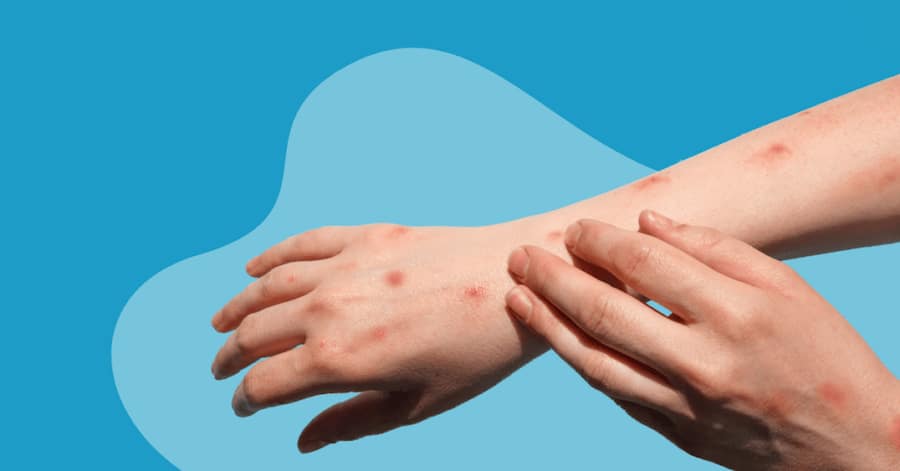 Monkeypox Infection: Australians Warned To Be On High Alert Against ...