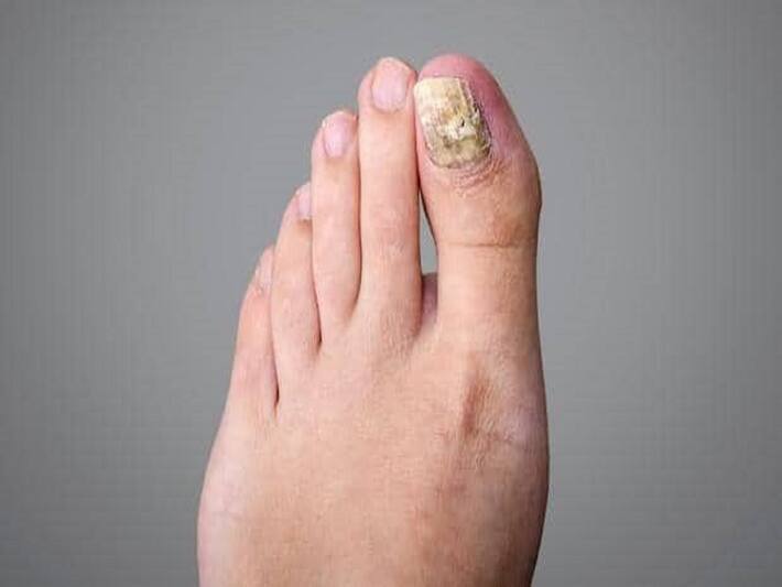 Nail Problems in Pictures | TheHealthSite.com
