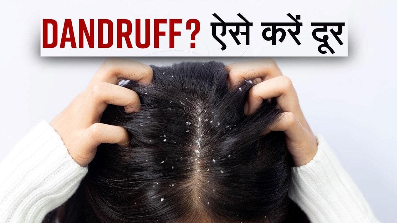 Dandruff Home Remedies: सिर के डैंड्रफ को इन 5 आसान घरेलू उपायों से ...