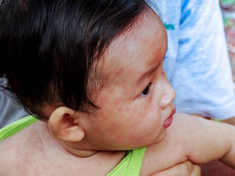 Measles Outbreak In Mumbai: How To Protect Your Child Against This ...