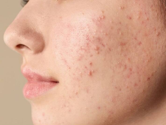 Chronic Constipation and Mood: How It Can Affect You Mentally ...