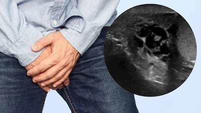 Worms Found In Testicles: Indian Man With Swollen Testes Discovers ...