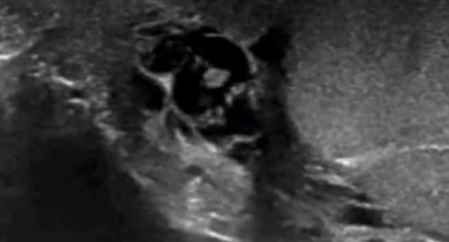 Worms Found In Testicles Indian Man With Swollen Testes Discovers Dancing Scrotal Worms Living