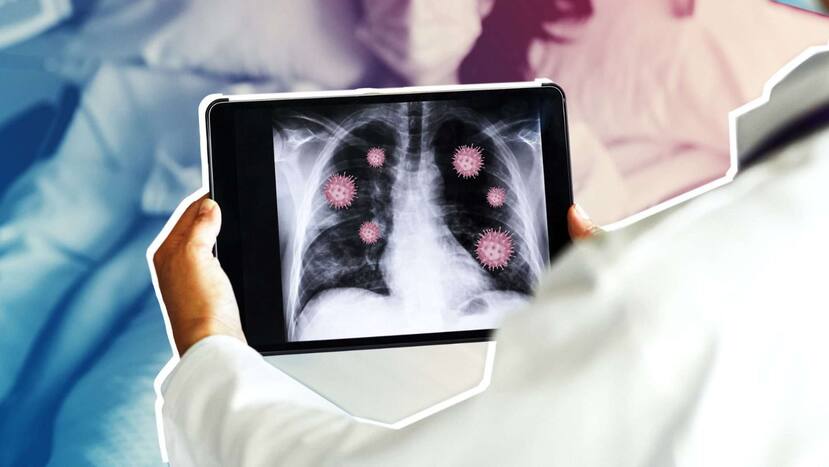 COVID-19 Pneumonia: Chronic Muscle Pain And Other Unusual Symptoms To ...