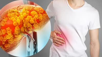 Fatty Liver: Excessive Fat Accumulation In The Liver Can Damage Your ...