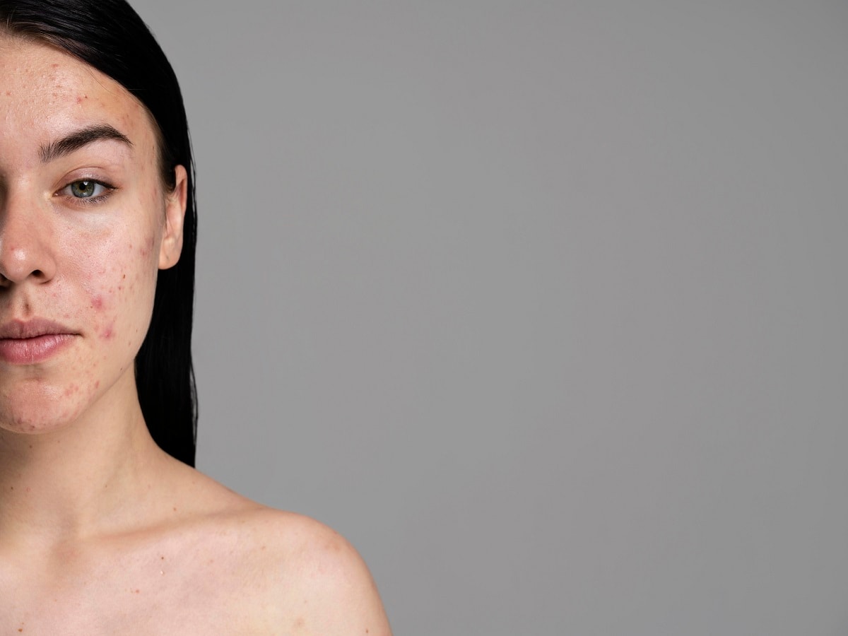 Facing Skin Issues? It Could Be Fungal Acne! | TheHealthSite.com