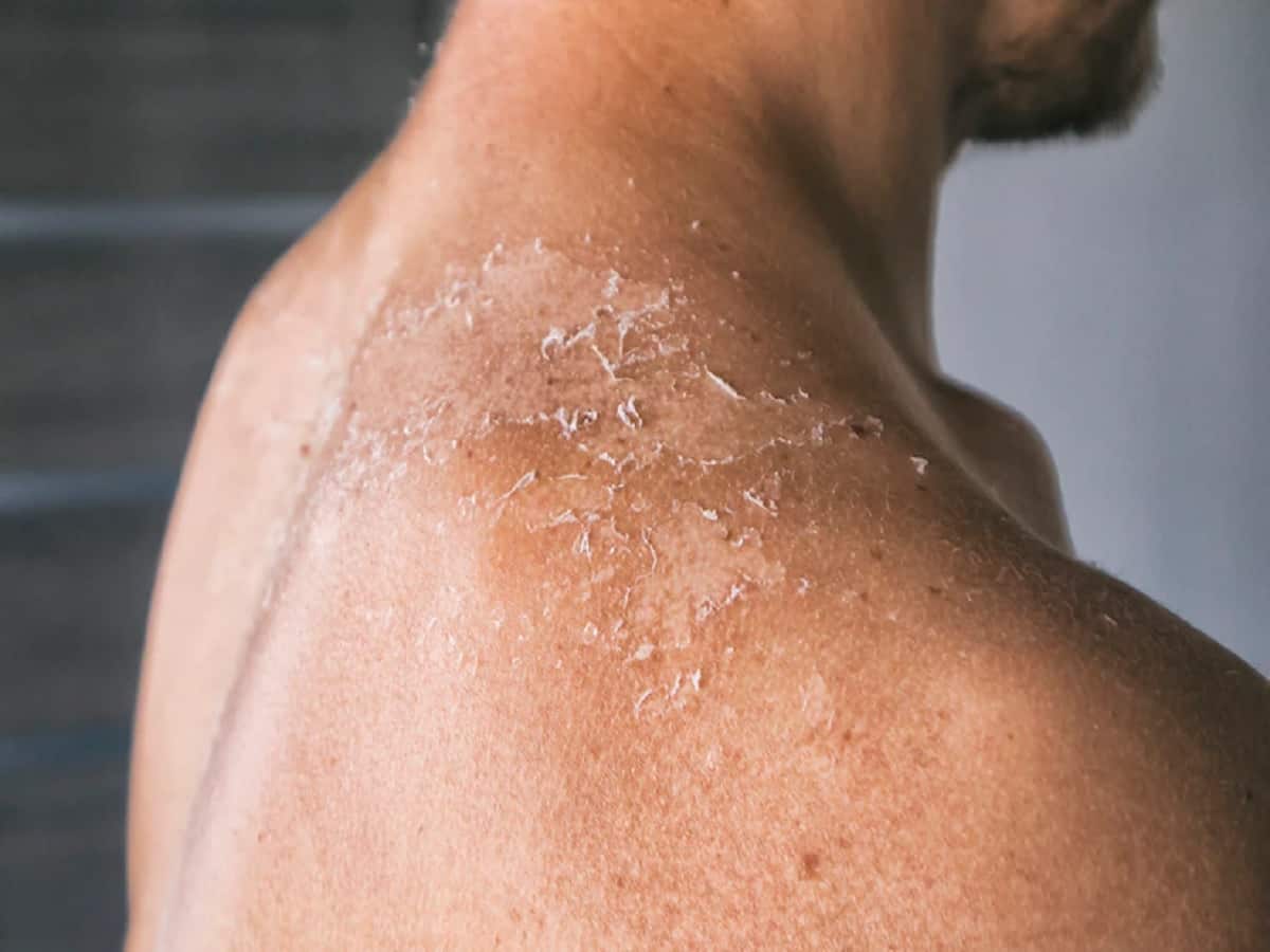Men Are At Higher Risk Of Developing Skin Cancer Know Why