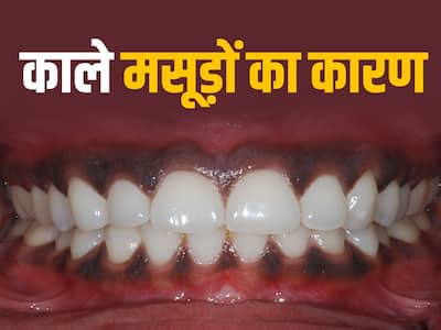 Masudo Ka Kalapan Kaise Dur Kare | मसूड़ों का कालापन कैसे दूर करे ...