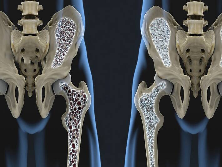 Bone Loss From Osteoporosis: Air Pollution Can Damage Your Bone Health ...